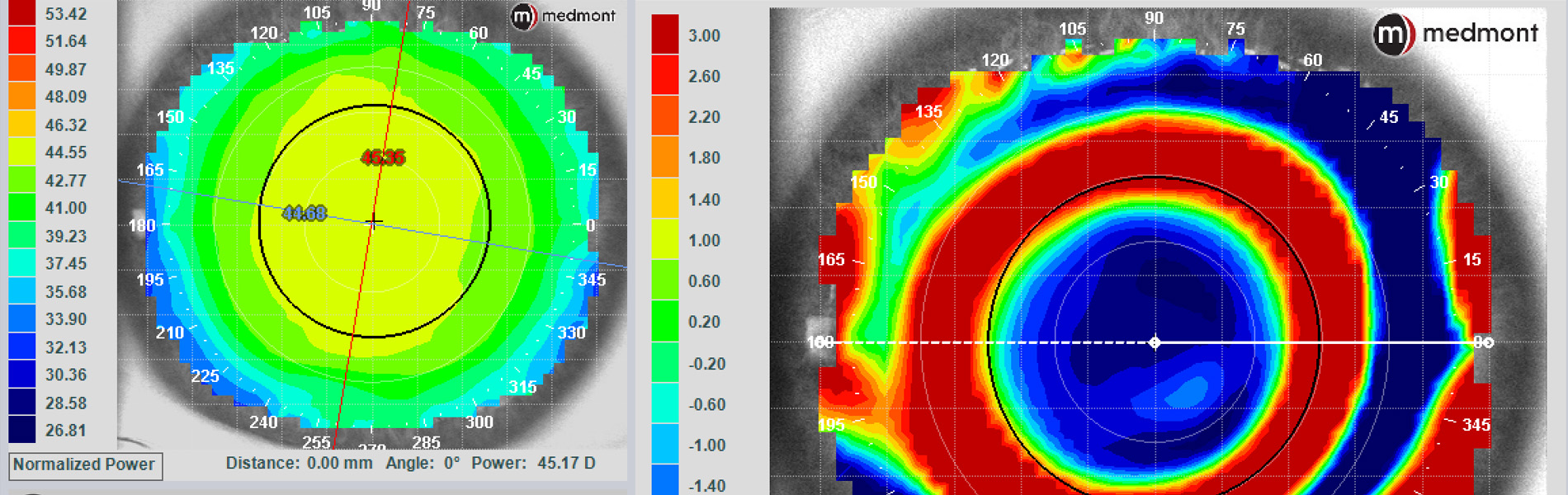 orthokeratology and myopia management - Parley Optometrists